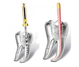 La reendodoncia - Dentisalut