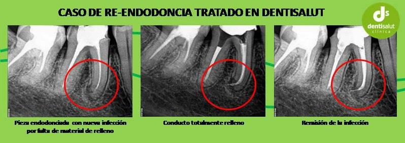 La reendodoncia - Dentisalut