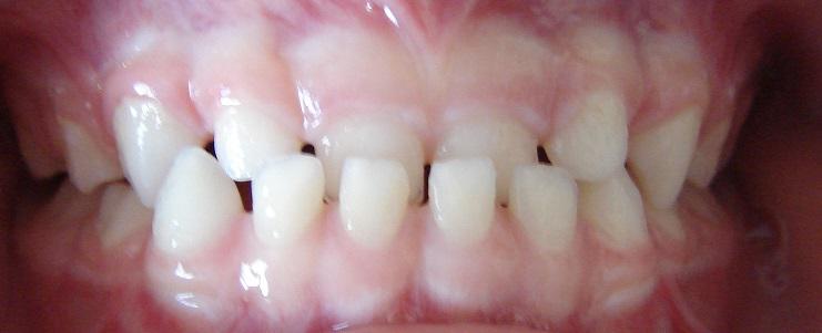 Mantenedores de espacios - Dentisalut