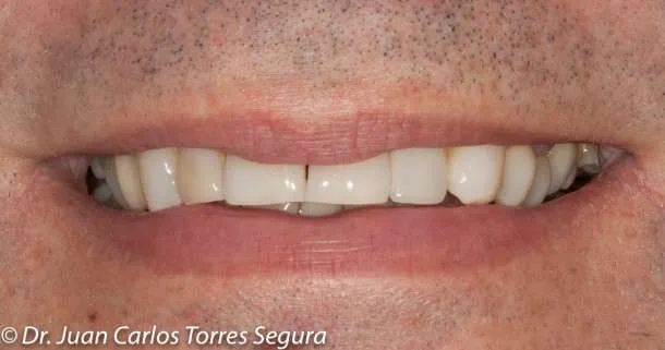 Nuevo caso del Doctor Torres: extracción del resto radicular ...