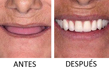 Qué son las prótesis dentales fijas - Dentisalut