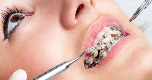 El retratamiento de ortodoncia - Dentisalut