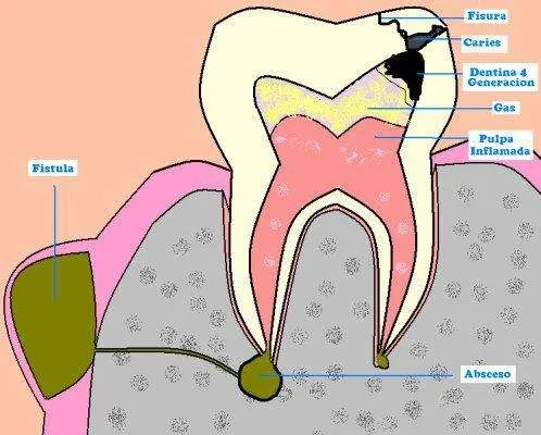 ¿Cuáles son los diferentes diagnósticos en endodoncia? - Dentisalut