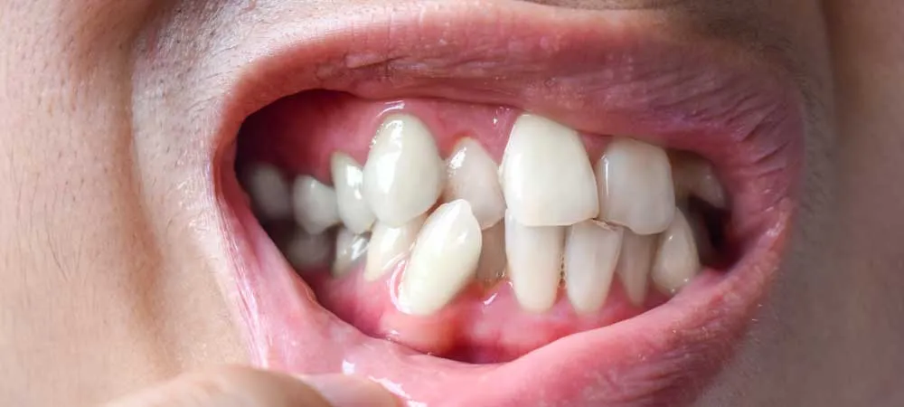 Los dientes supernumerarios y sus efectos dentales - Dentisalut