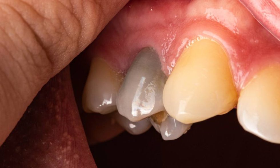 Principales soluciones a la necrosis dental - Dentisalut