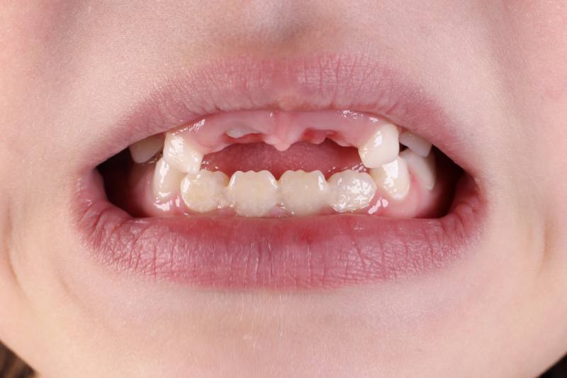 ¿Pérdida prematura de dientes en niños? ¿Qué hacer? - Dentisalut