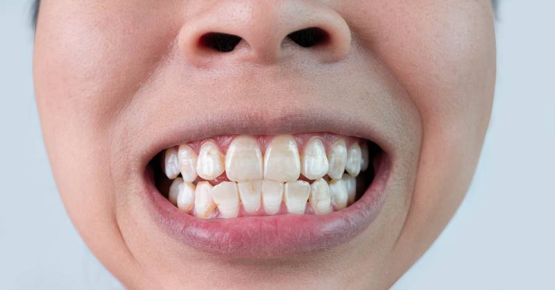 Manchas blancas en los dientes, ¿por qué salen? - Dentisalut